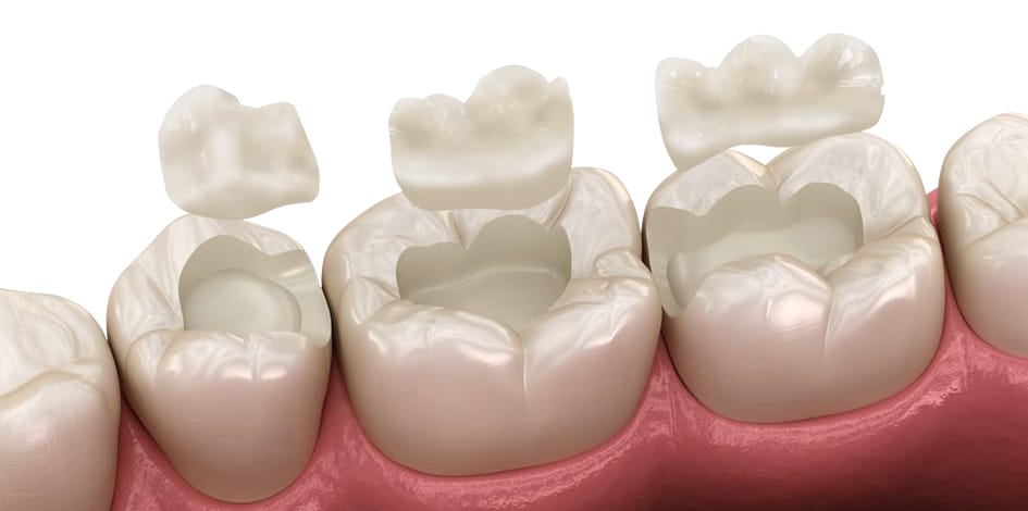 Inlays and Onlays in Elmhurst,IL - Cosmos Modern Dental Elmhurst